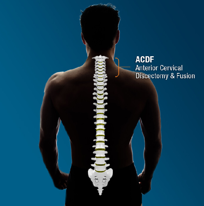 ACDF :: Inspired Spine SurgCenter