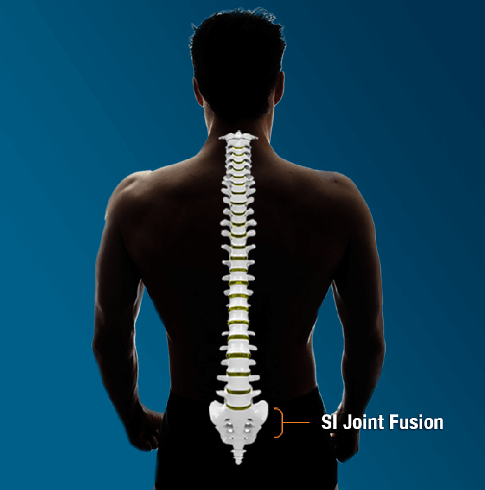 SI Joint Fusion :: Inspired Spine SurgCenter